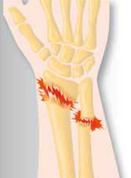 Sportverletzungen: Knochenbruch » mobilesport.ch